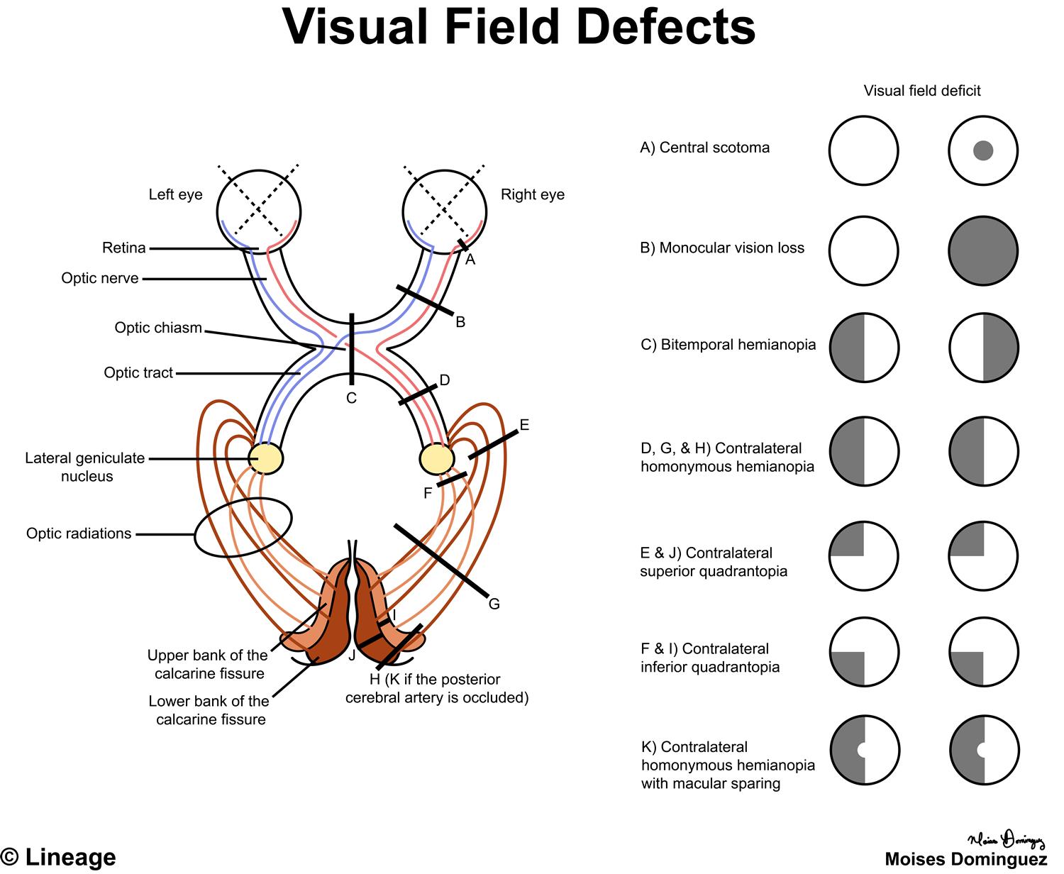 Prolactinoma USMLE Strike Prolactinoma USMLE Strike